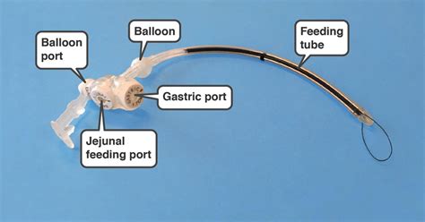 Gastrostomy Tube To Gastrojejunostomy Conversion