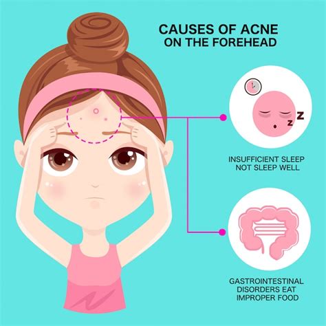 Premium Vector Causes Of Acne On The Forehead