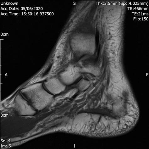 Undisplaced Fracture Distal Tibial Metaphysis Cases Home