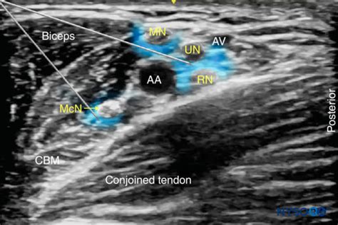 Ultrasound Guided Axillary Brachial Plexus Block NYSORA