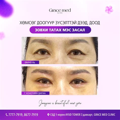 ЗҮГЭЭЭР Л 🤩 Grace Med гоо сайхан мэс заслын эмнэлэг Facebook