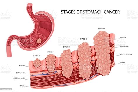 위암 단계 성장 악성 암 종양 해부학적 벡터 삽화 격리된 흰색 배경 만화 스타일 건강관리와 의술에 대한 스톡 벡터 아트 및 기타 이미지 건강관리와 의술 건강한 생활방식