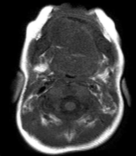 Dermoid Cyst Floor Of Mouth Radiology