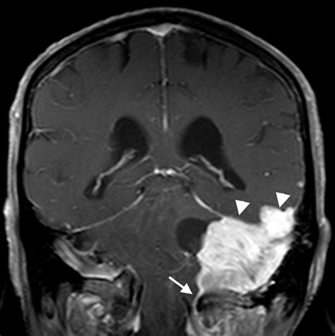 Cerebellopontine Angle Cistern Imaging Of Cerebellopontine Angle