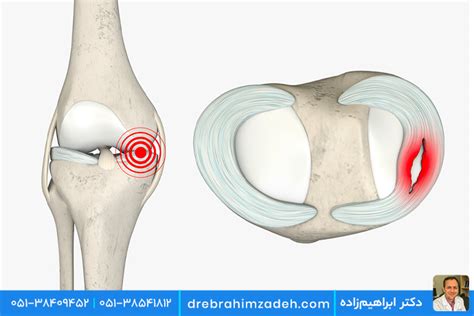 پارگی مینیسک زانو، تشخیص و راه‌های درمان دکتر ابراهیم زاده