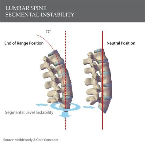 Lower Back Lumbar Segmental Instability Lower Back Lumbar Segmental Instability