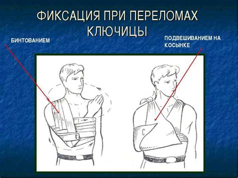 Перелом ключицы. причины, симптомы, виды, первая медицинская помощь и ...