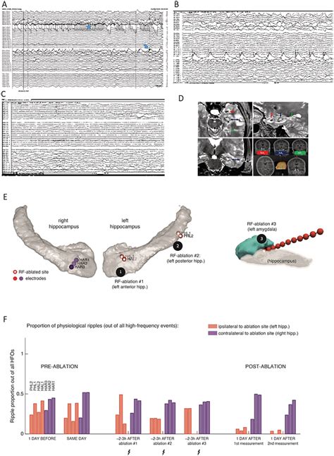Pre‐ And Post‐rf Hfo Analysis A Seeg Manifests Left Download