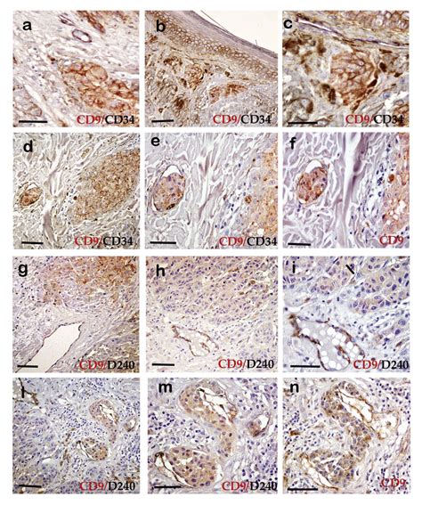 Cd9 Re Expression In Positive Tumor Clusters Near Or Inside Blood And