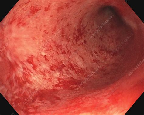 Colon In Ulcerative Colitis Endoscope View Stock Image C060 9301