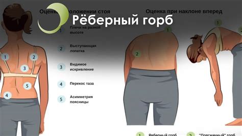Реберный горб почему при сколиозе спина выглядит некрасиво Youtube
