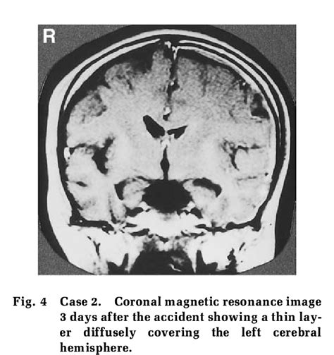 Case 2 Computed Tomography Scans On Admission Left Showing An Acute
