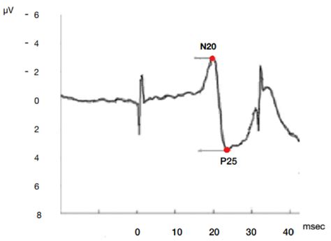 Model Of Ssep N20p25 Cortical Complex Wave Onset And Peak Amplitude And Download Scientific