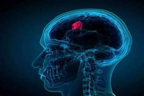 மூளை கட்டி பிரச்சனையை தடுக்கும் 5 உணவுகள் ஜே வி பி நியூஸ்