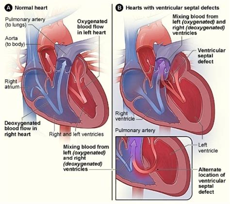 Congenital Heart Defects Symptoms