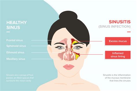 Nose Infection Symptoms