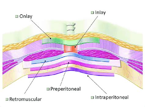 Types Of The Incisional Hernia Repair According To Mesh Fixation Areas