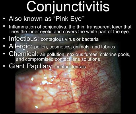 Conjunctivitis