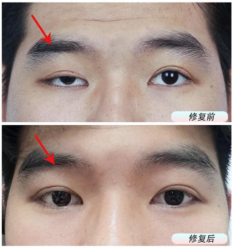 右眼先天性重度上睑下垂修复CFS术后3月 知乎