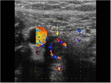 Abdomen And Retroperitoneum 1 5 Appendix Case 1 5 2 Uncomplicated Appendicitis Ultrasound