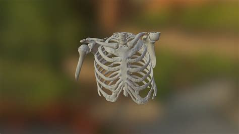 Rib Fracture 1 3d Model By Fablabndmc [d1efb4f] Sketchfab