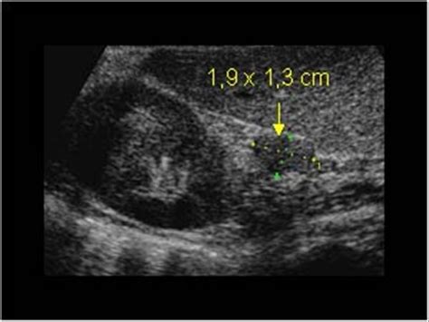 Abdomen And Retroperitoneum 110 Adrenal Glands Case 1102 Adrenal Adenomas Ultrasound Cases Abdomen And Retroperitoneum 110 Adrenal Glands Case 1102 Adrenal Adenomas Ultrasound Cases