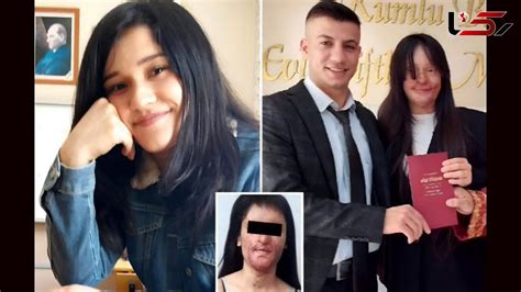 ازدواج یک دختر با پسری که به صورتش اسید پاشید عکس