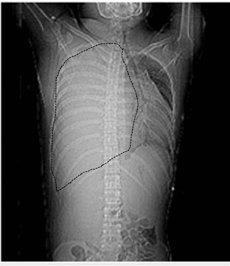 Chest X Ray Cxr Cxr Shows Complete Opacification Of The Right