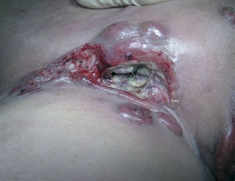 Polypropylene Mesh Implantation In Combination With Vacuum Assisted