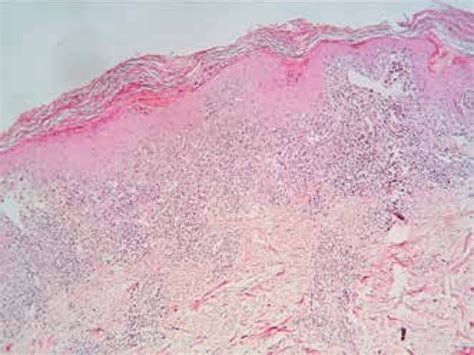 Figure 3 From Lichen Planus Lupus Erythematosus Overlap Syndrome Semantic Scholar