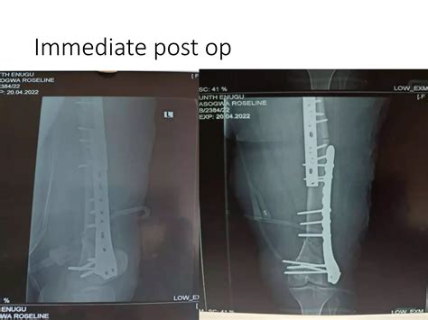 Treatment Of Segmental Femoral Fracture Pptx