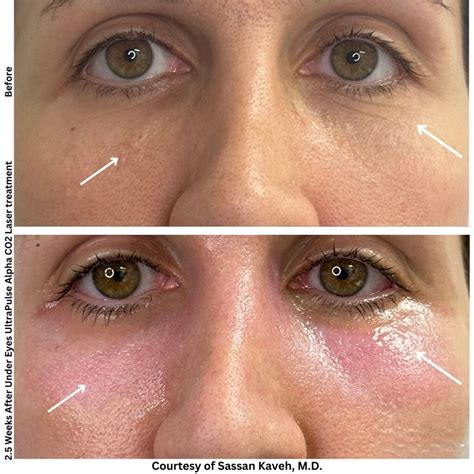 Co2 Laser Resurfacing Around Eyes The Best Non Surgical Fix For Fine