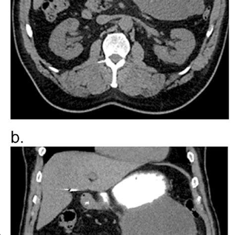 Ct Scan Of Gastrointestinal Stromal Tumor Gist Prior To Surgery A