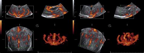 Spatio Temporal Imaging Correlation To Measure Tissue Impedance In The Neonatal Brain Adc