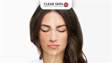 Unlocking The Mystery Of Mandibular Melasma And Centrofacial Melasma