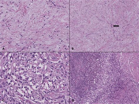 Occasional Areas Of The Tumor Consisted Of Myxoid Stroma A And Download Scientific Diagram
