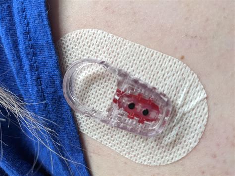 Before And After Calibration Red Arrow R Dexcom