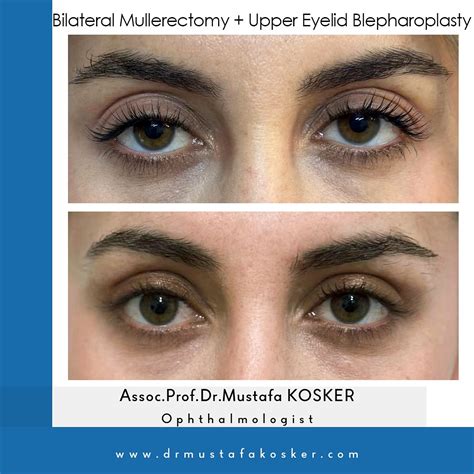 Bilateral Mullerectomy And Upper Doç Dr Mustafa Köşker Facebook
