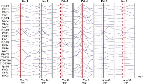 Averaged Epileptic Spikes For Patients 16 The Red Vertical Lines