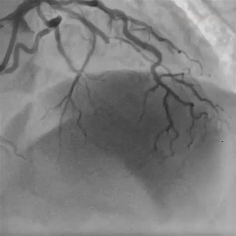 How Pci For Lad Occlusion In 72 Year Old Male Innvolution Healthcare Private Limited Posted On