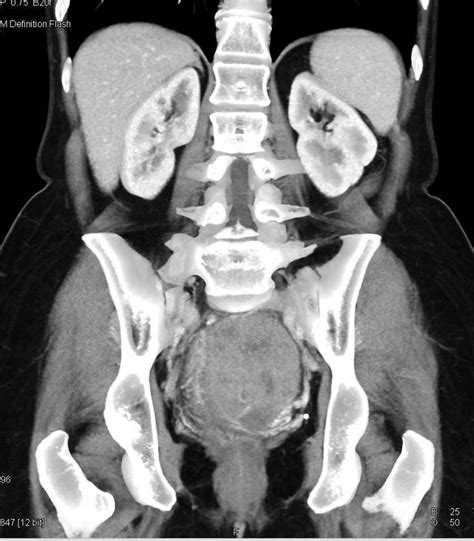 Rectal Gist Tumor In 2025 Rectal Case Study Tumor