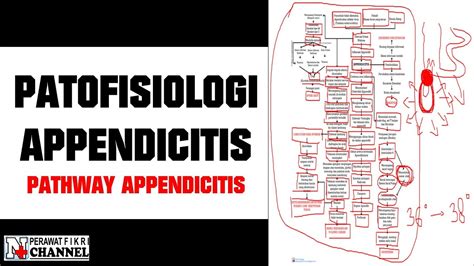 Patofisiologi Appendicitis Pathway Appendicitis I Download File Cek