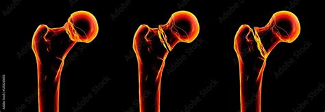 Femur Neck Fracture Types Subcapital Transcervical And Basicervical