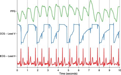 Example Of A False Alarm Which Incorrectly Asserted The Patient Was In Download Scientific