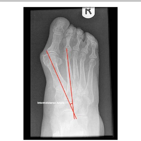 Intermetatarsal Angle Download Scientific Diagram