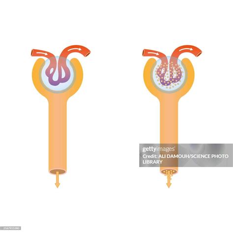 Diabetic Nephropathy Illustration High Res Vector Graphic Getty Images