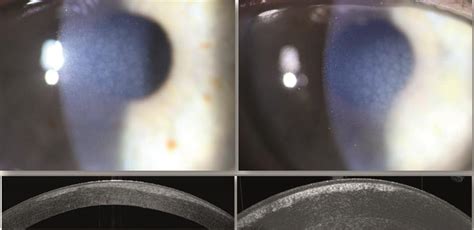 Fuchs Endothelial Dystrophy