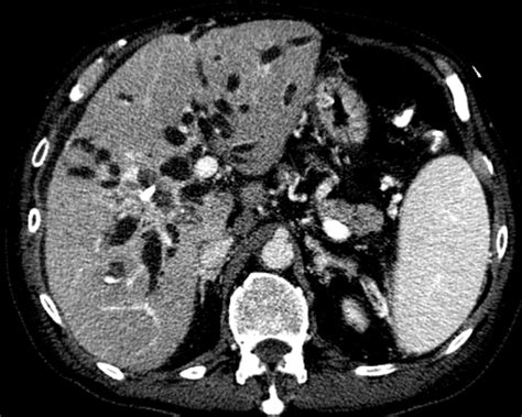 Liver Atlas Case 27 Cholangiocarcinoma