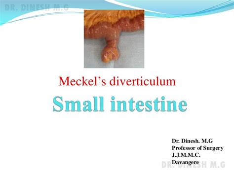 Meckels Diverticulum