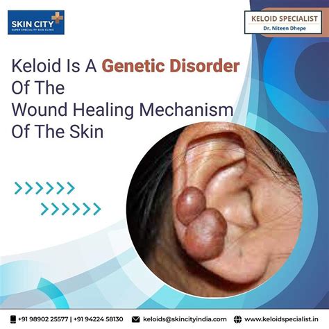 Keloidgeneticdisorder Relief By Keloid Pune Fine Art America